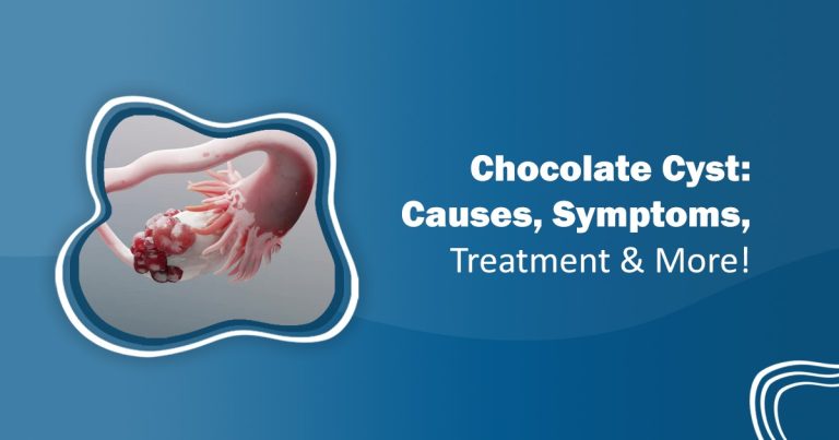 Chocolate Cyst: Symptoms, Risks & Best Treatment Methods
